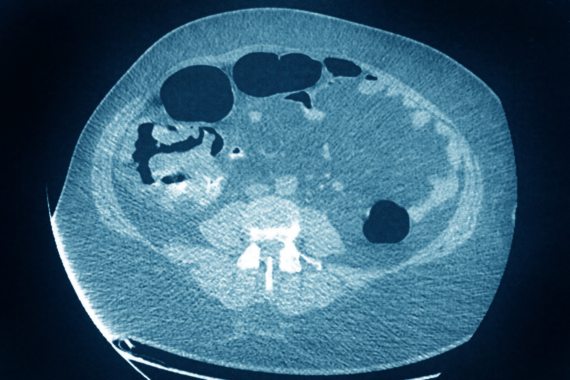 What are the warning signs of colorectal cancer?