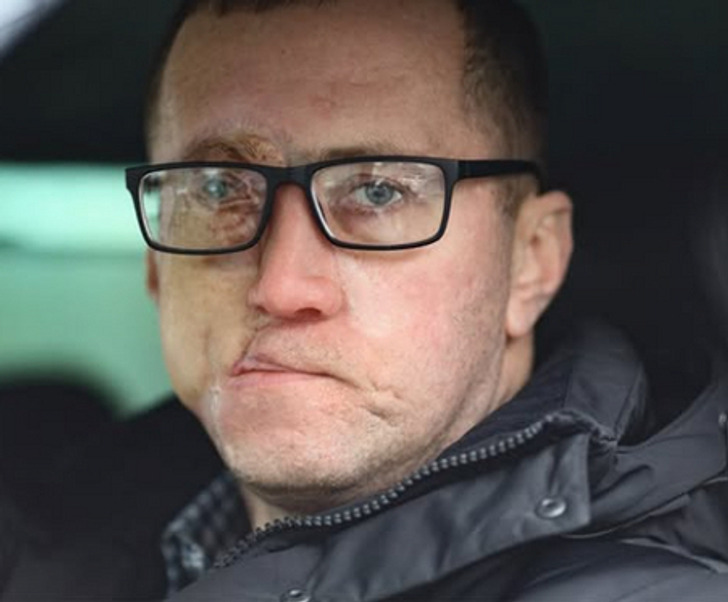 Tattoo Artist Turns Pain Into Art With Hyper-Realistic Eye Tattoo for ...