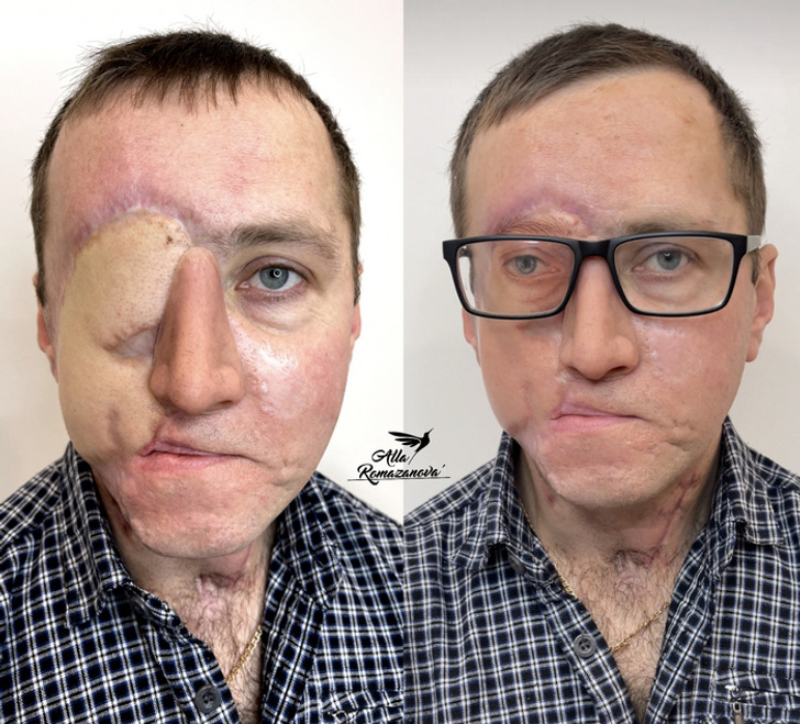 Tattoo Artist Turns Pain Into Art With Hyper-Realistic Eye Tattoo for ...