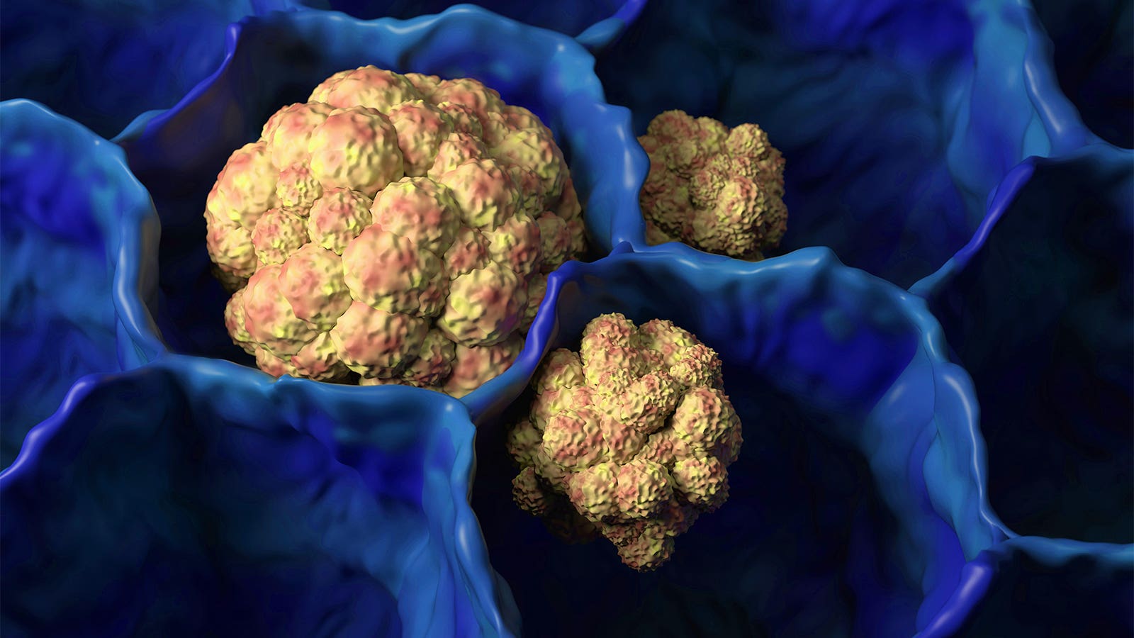 Tumor-Infiltrating Clonal Hematopoiesis Increased Risk of Poor Outcomes ...