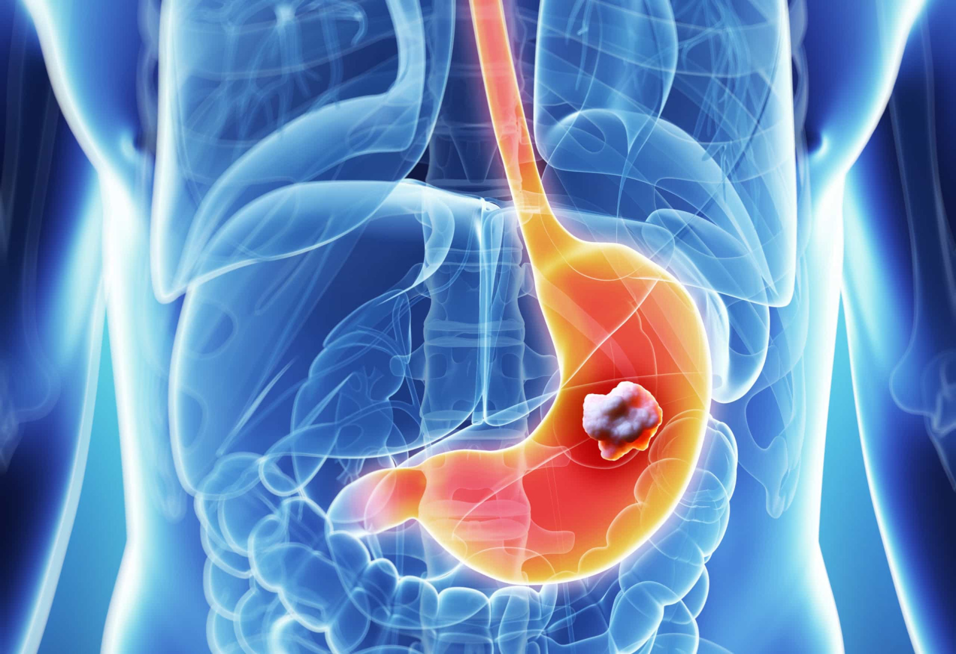 Do you know the warning signs of stomach cancer?