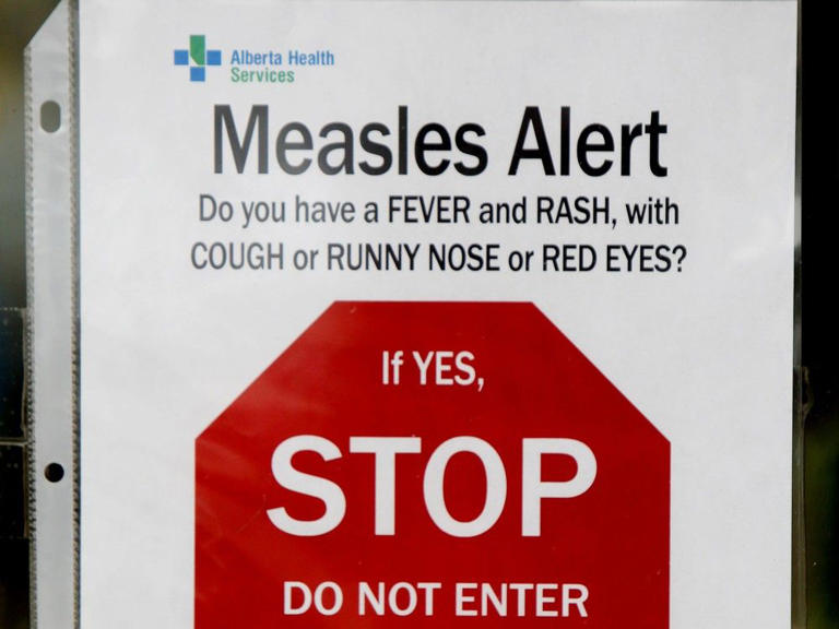 Measles exposure alerts issued for Medicine Hat, Lethbridge and ...
