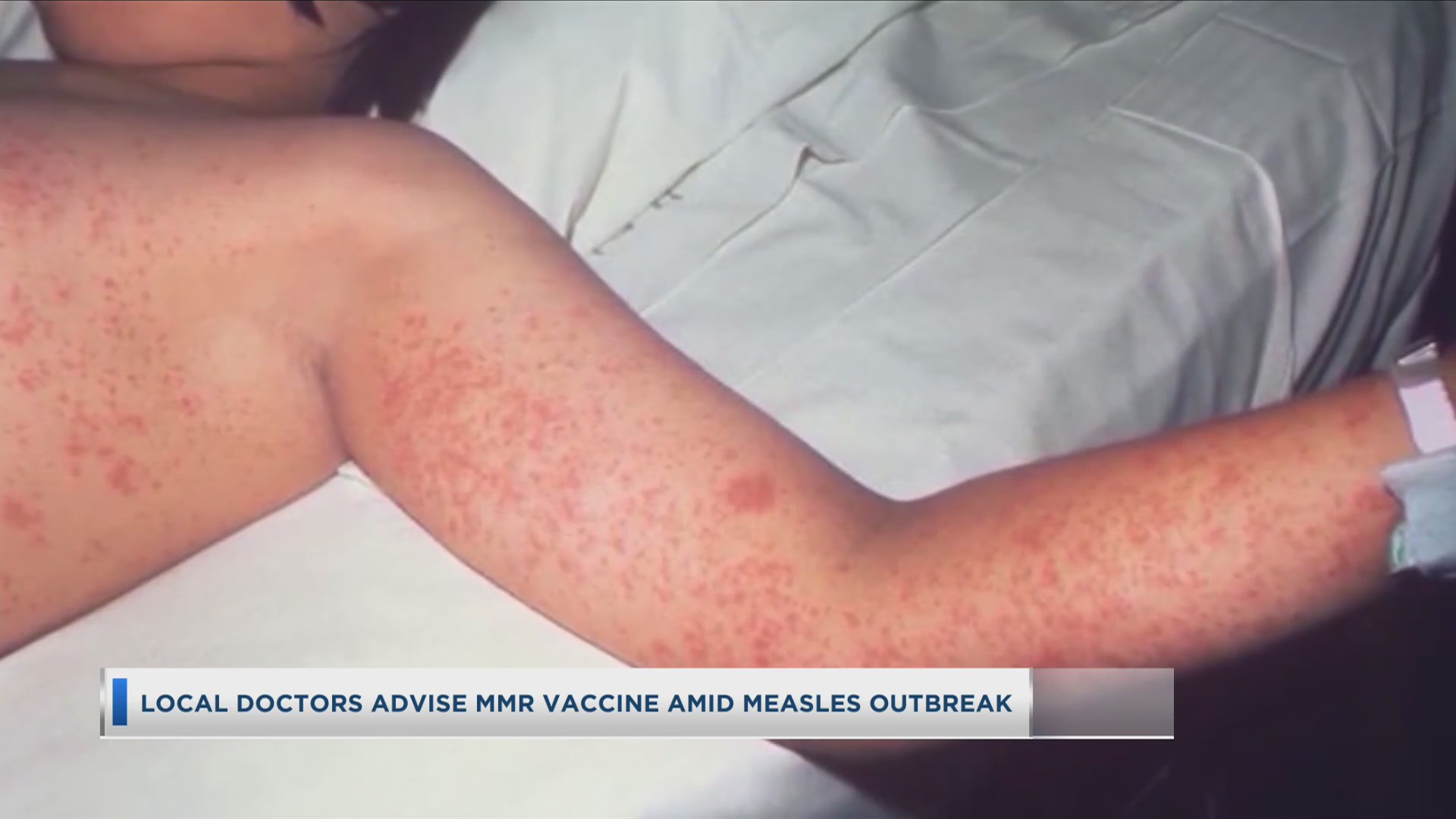 Local Doctors Advise MMR Vaccine Amid Measles Outbreak