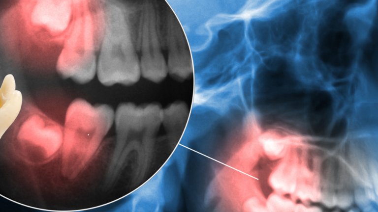 When Is It The Right Time To Get Your Wisdom Tooth Extracted?