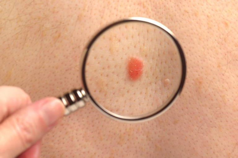 Melanoma: The early warning signs you could have the most dangerous ...
