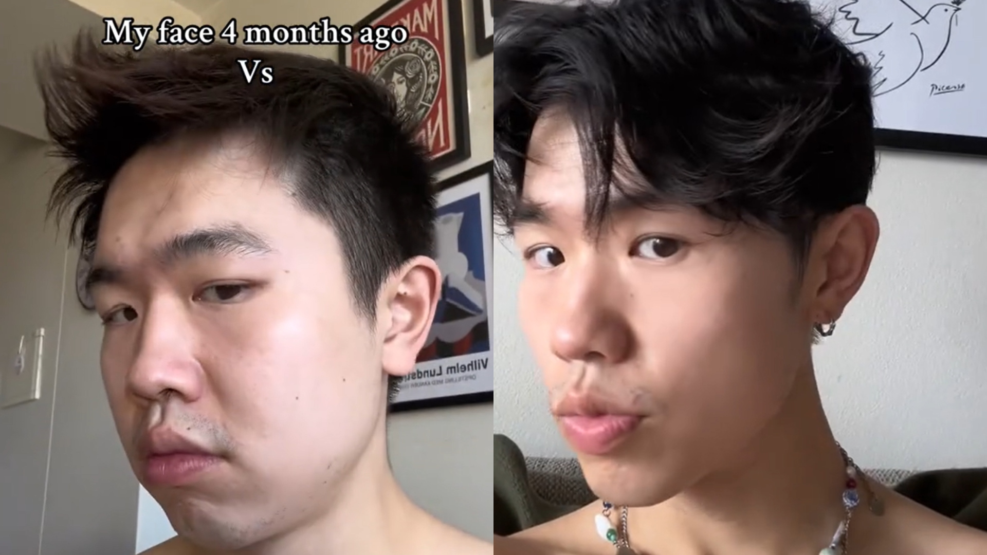 Den typiske "looksmaxxing"-stil, hvor mænd slår sig i ansigtet for at ...