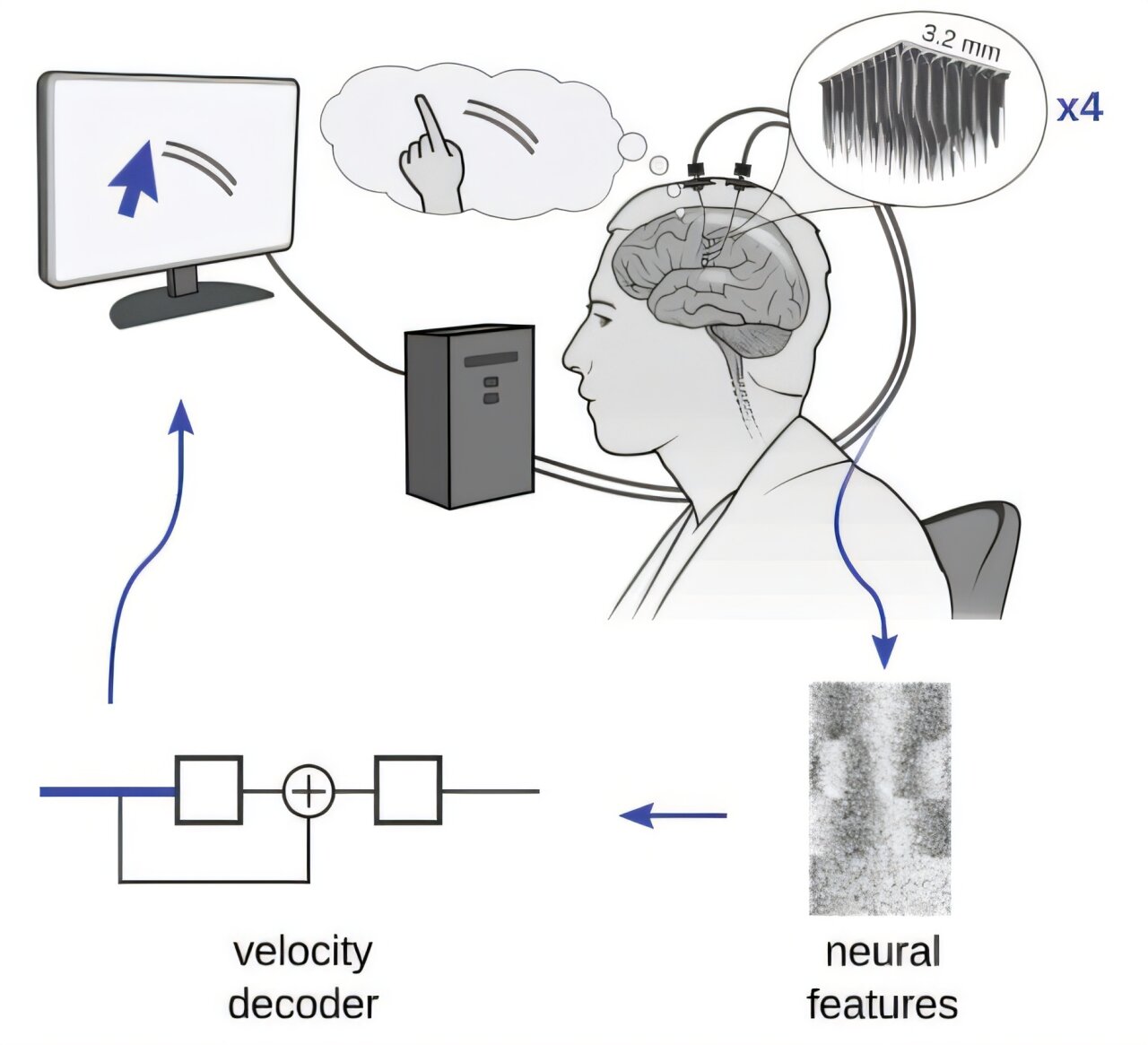 Brain interface allows speech decoding and computer control in ALS patient