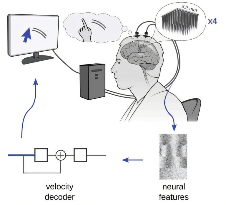 Brain interface allows speech decoding and computer control in ALS patient