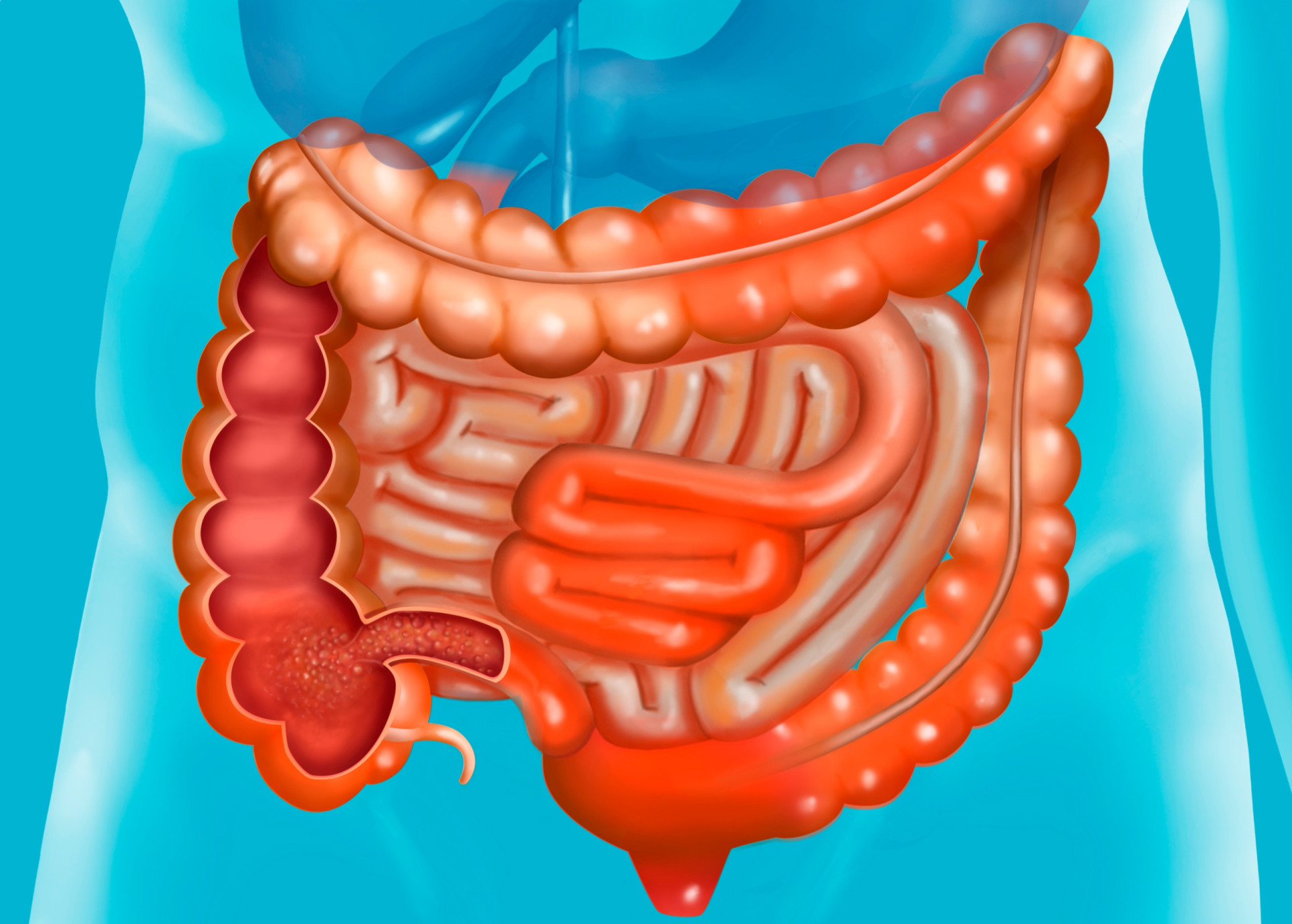 Inflammatory bowel disease: everything you need to know