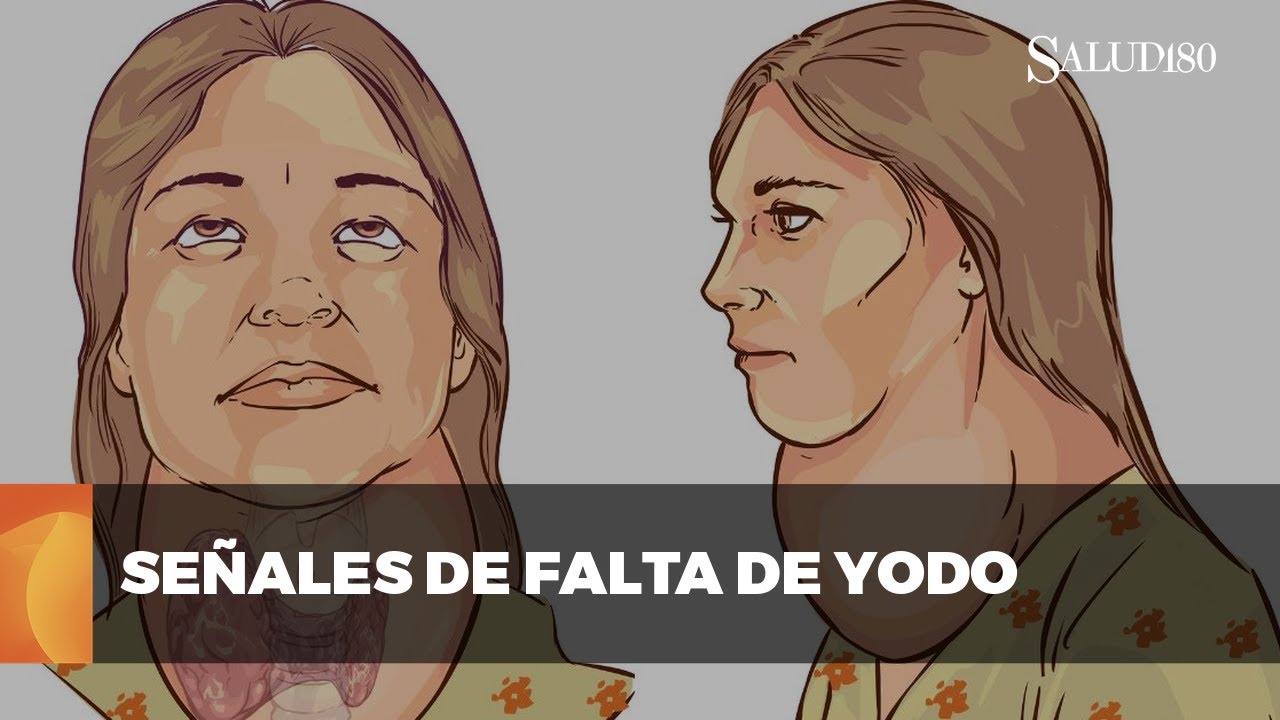 Así grita tu cuerpo que necesita yodo | Salud 180