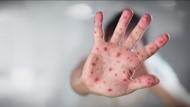 Possible measles case in Vallivue School District