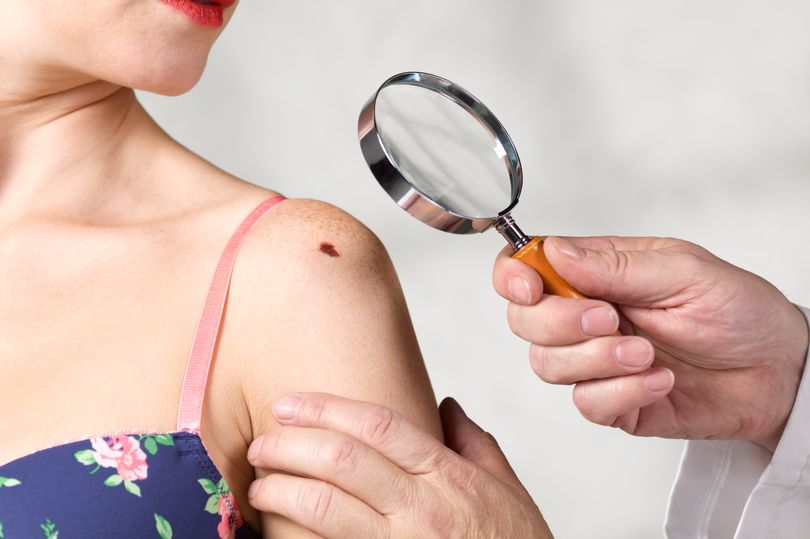 Five skin cancer red flags everyone should look out for