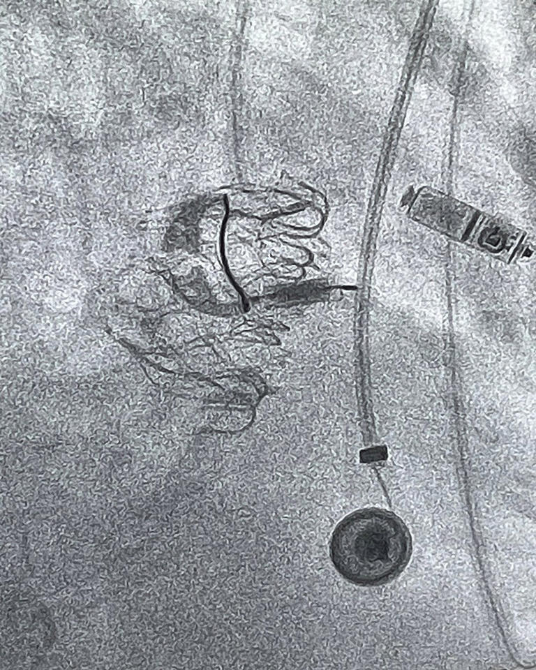 Sarasota Memorial Hospital cardiologists use new device for tricky heart valve procedure