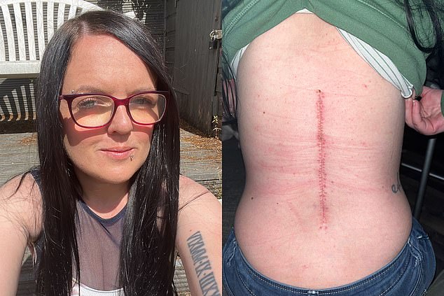 I was told my 'shooting' back pain was normal for 10 years - it was ...