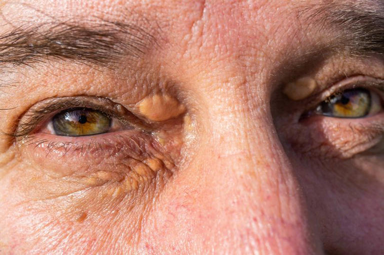 Symptom of high cholesterol can be spotted in eyes - and increases ...