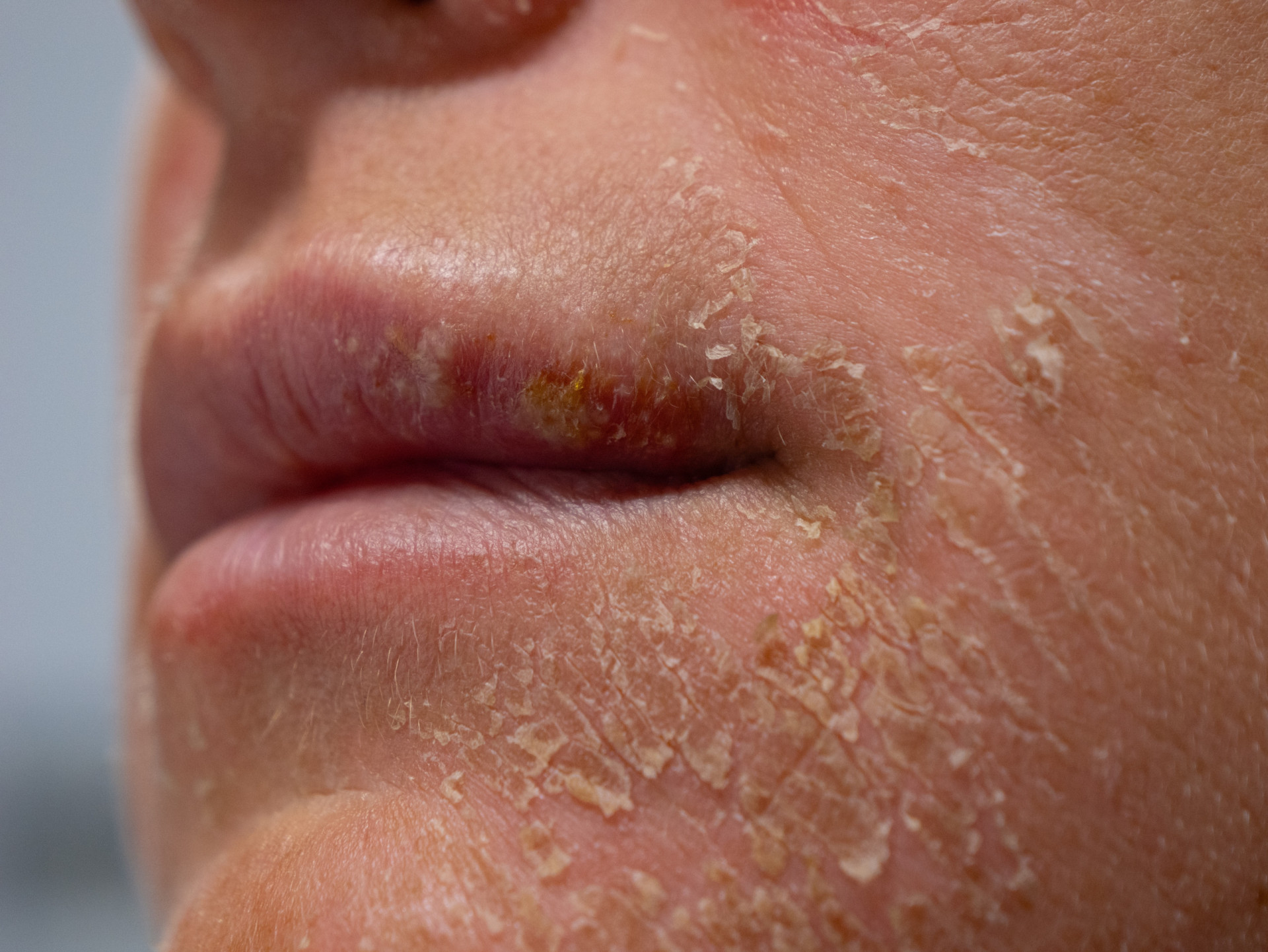 Vitamin D: The effects of too much and too little sunlight on human health