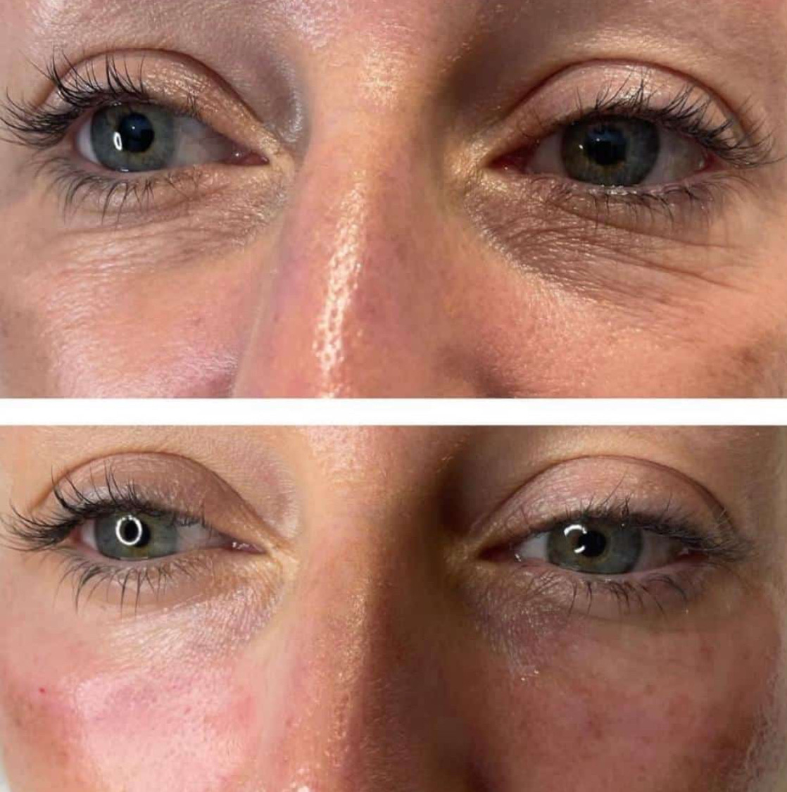 Polynucleotides Facial Treatment For Skin Regeneration