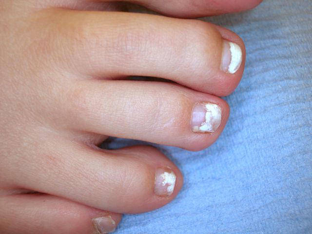 What Are the 4 Different Types of Toenail Fungus?