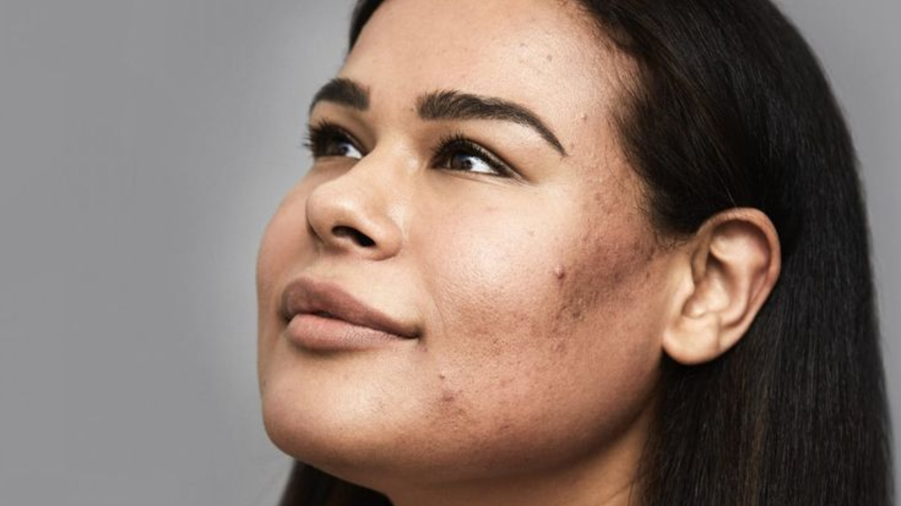 Summer acne struggles? Here’s how to keep breakouts at bay