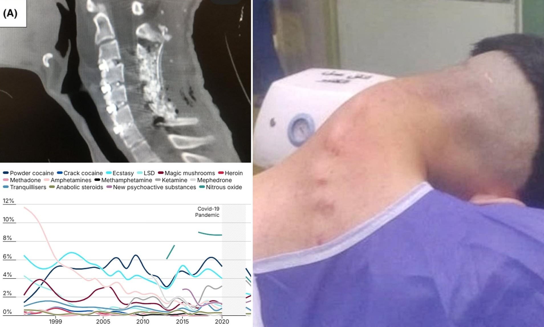 Man develops shocking 'dropped head syndrome' after battling addiction ...