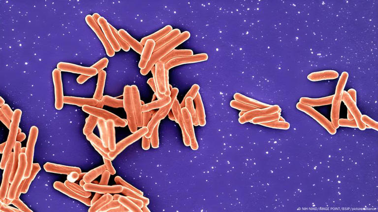 Undiagnosed TB poses challenge for South Africa, Mozambique