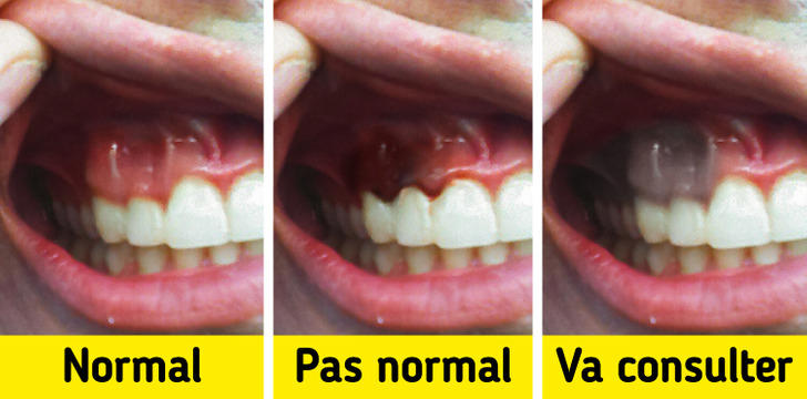 5 Choses que tes gencives essaient de te dire sur ta santé