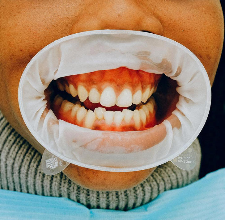 5 Choses que tes gencives essaient de te dire sur ta santé