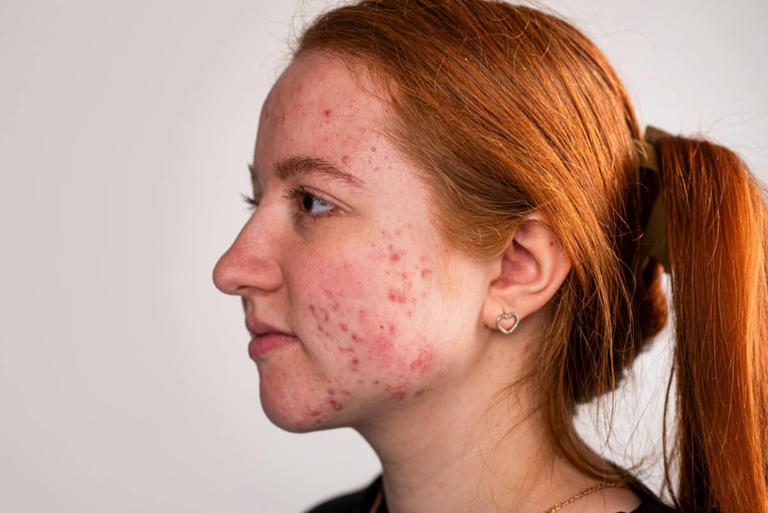 Facial Bacteria Come And Go Your Entire Life — But For Acne, One Key ...