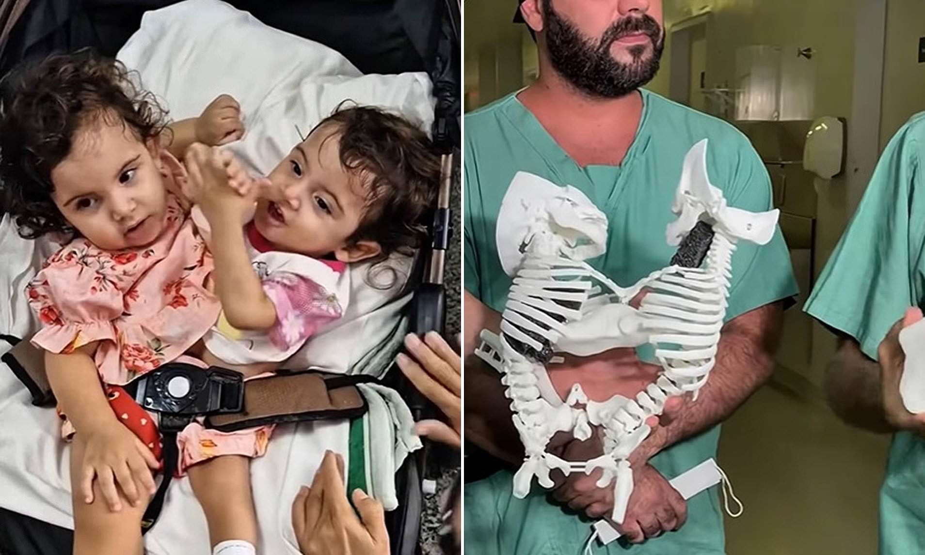 Conjoined twins attached at the chest, belly and pelvis are separated ...