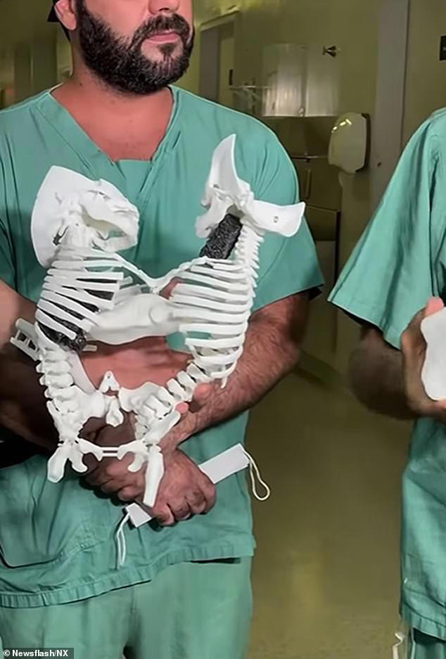 Conjoined twins attached at the chest, belly and pelvis are separated ...
