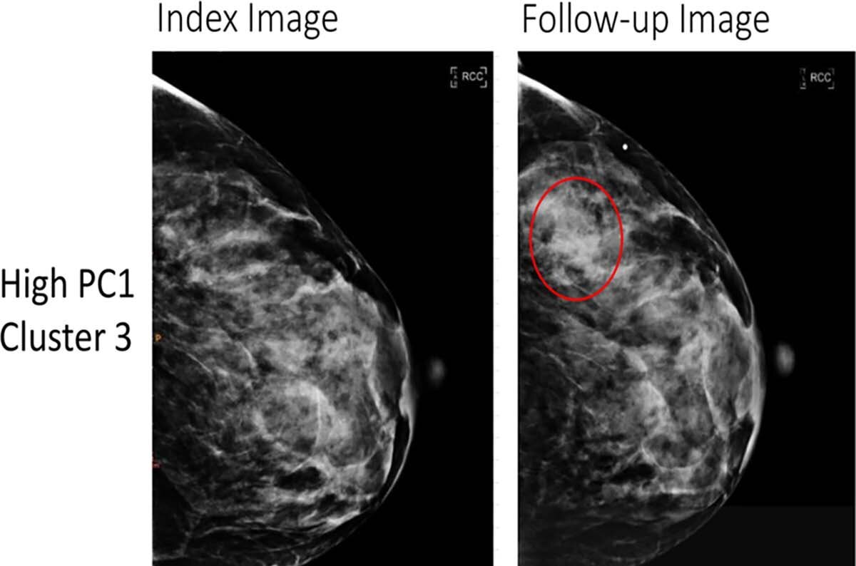 Six breast texture patterns linked to higher risk of invasive cancer