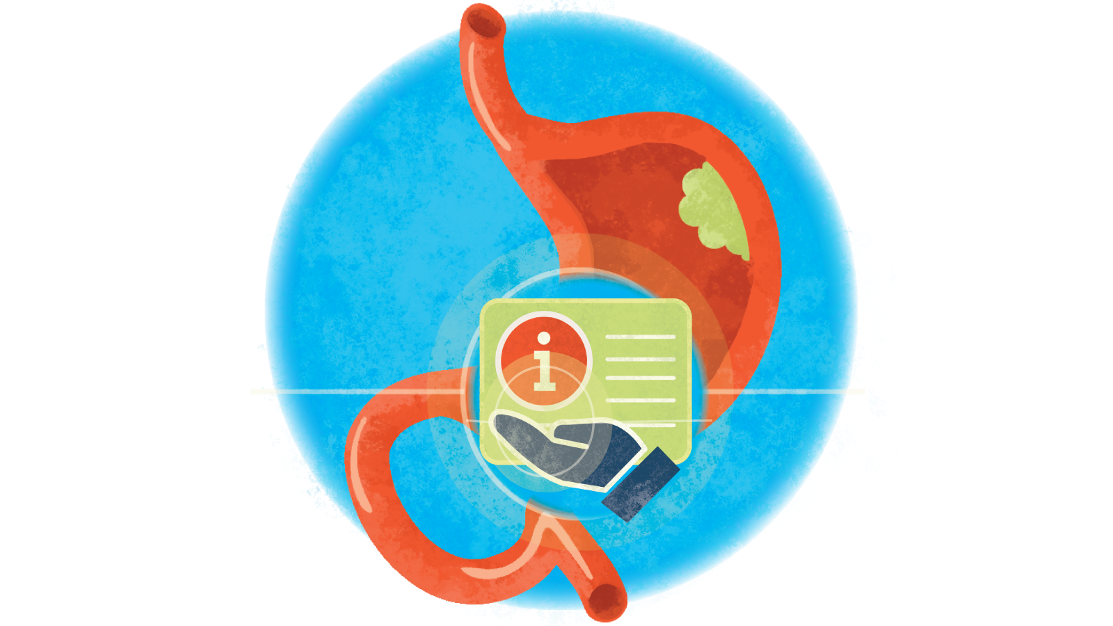 For Your Patients: What Is Gastric Cancer?