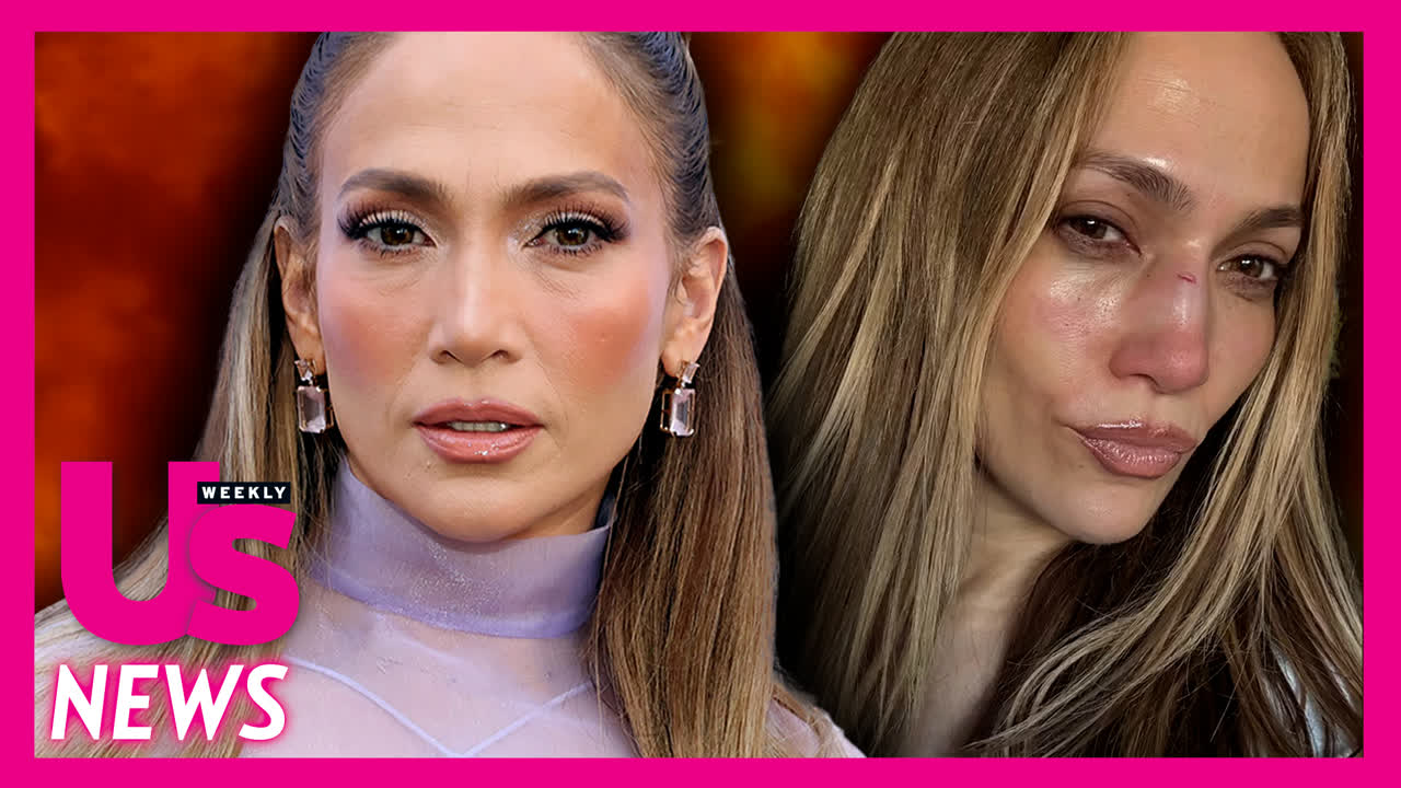 Jennifer Lopez Shares Photos of Severe Facial Injury From AMAs Rehearsals
