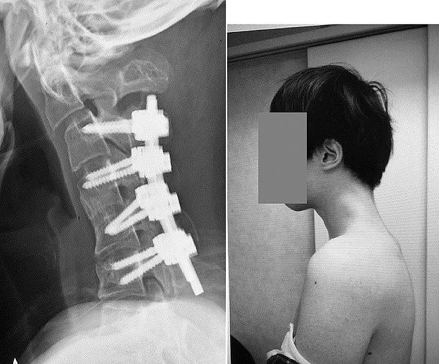 Gamer, 25, develops terrifying 'dropped head syndrome' from looking at ...