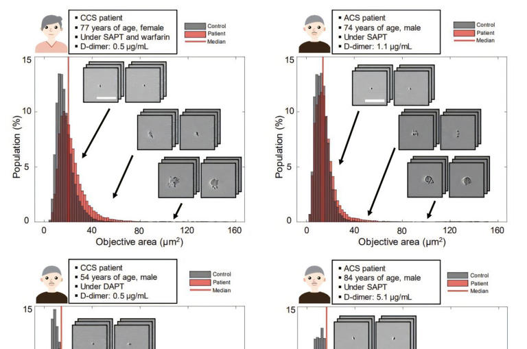 Seeing blood clots before they strike: Imaging technique shows how ...