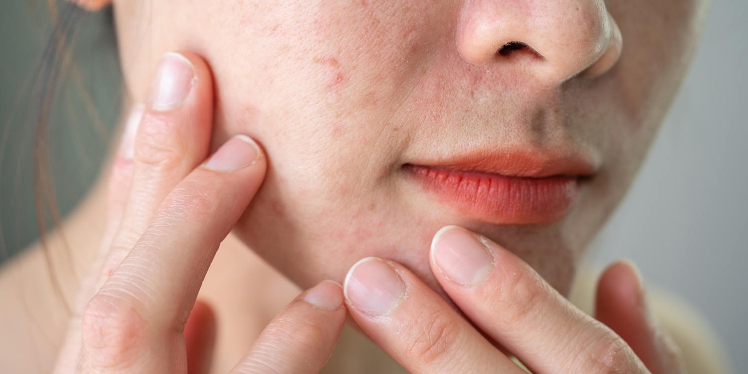 Yes, you can vacuum your face — here’s how pore vacuums can safely ...