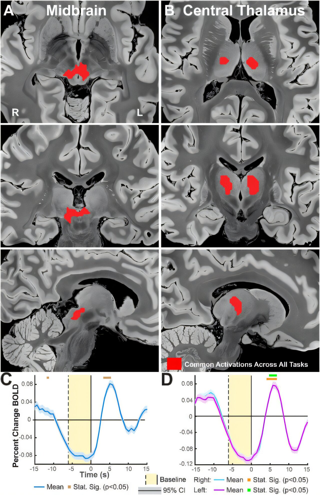 Deep brain regions link all senses to consciousness, study finds