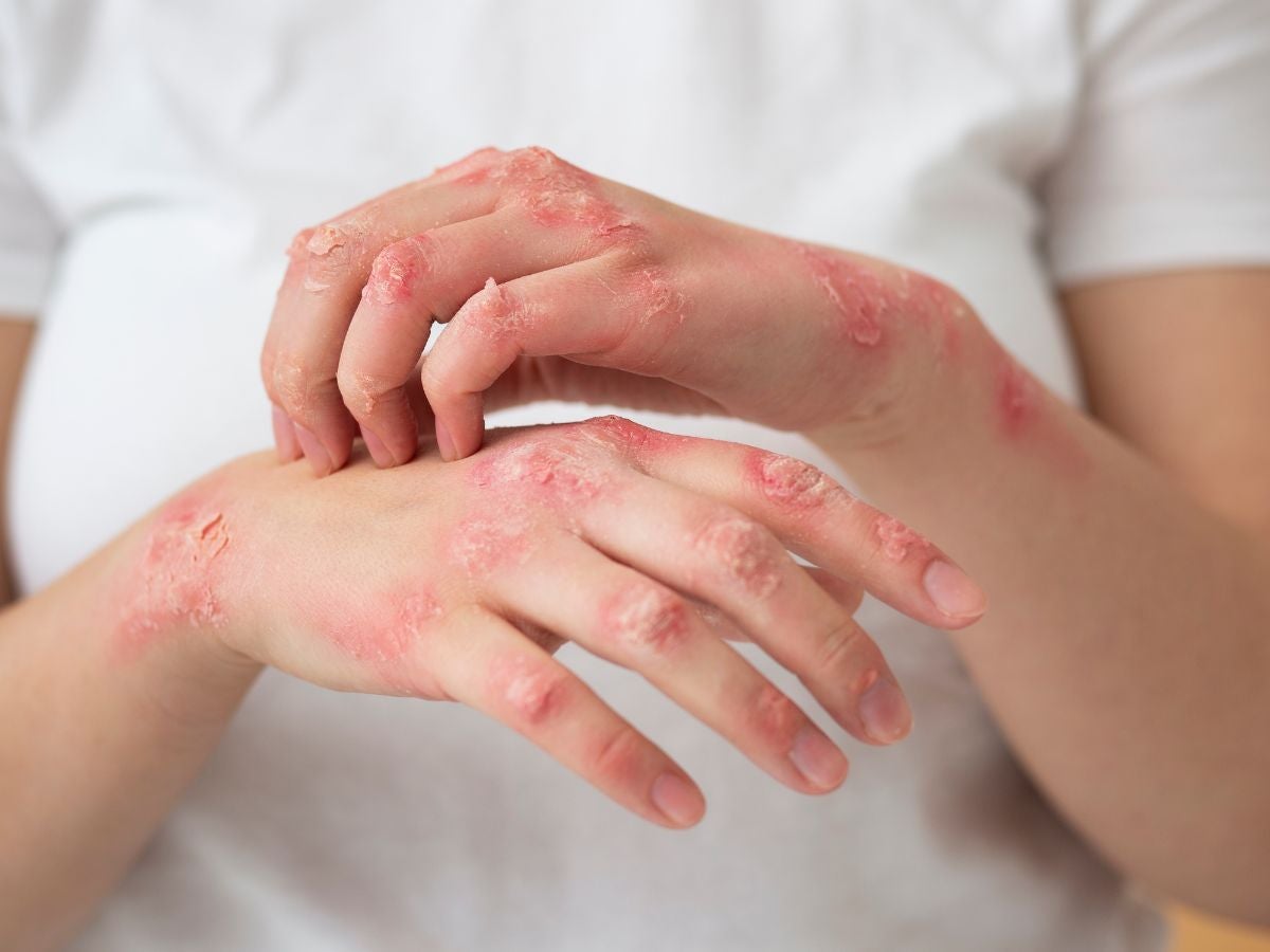 ¿Te salen ronchas cuando sube la temperatura? Descubre qué es la ...