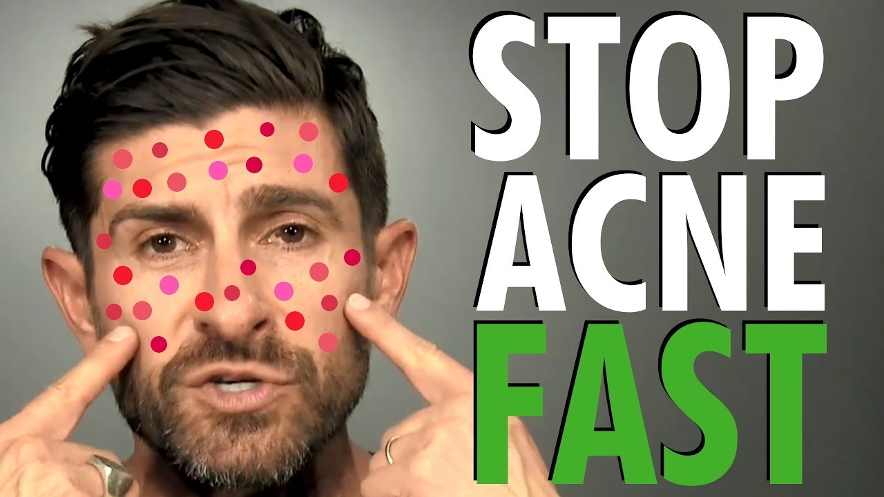 How To Get Rid Of Acne Fast - Best Acne Treatment For Clear Skin (Men's ...