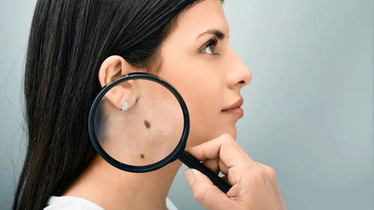 Understanding the hidden meanings of lucky moles on the female body