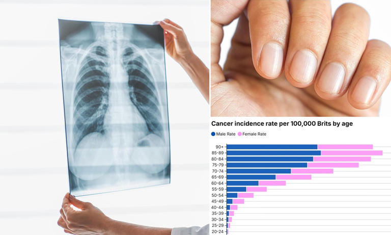 The little-known change to your FINGERTIPS that's an early warning sign of deadly cancer