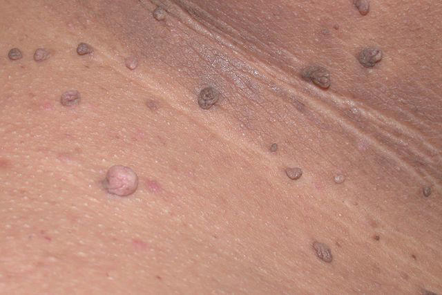 Wart vs. Skin Tag: How to Identify Which One You Have