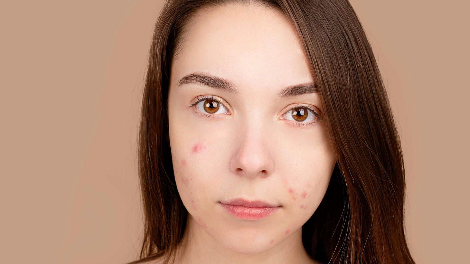 20 Strategies For Helping Your Teen Survive Acne