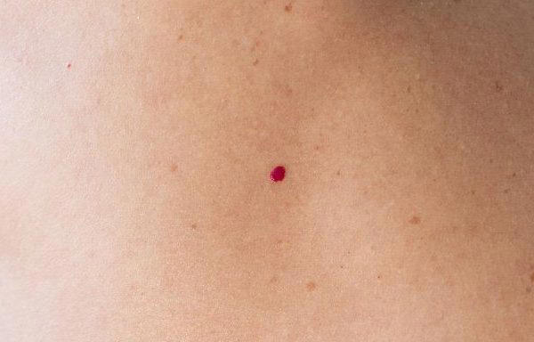 Ce petit point rouge sur votre peau ne part pas ? Voici ce que cela ...