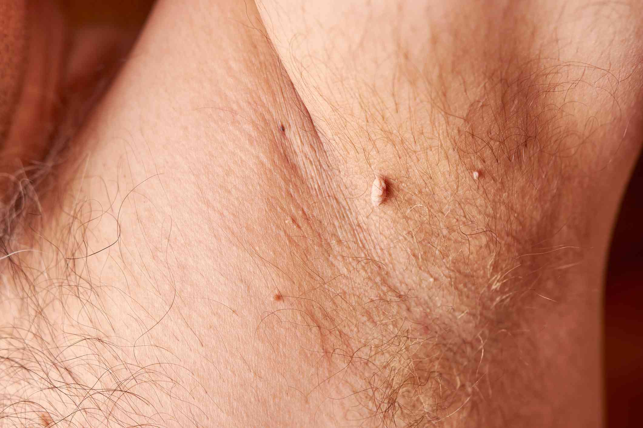 Wart vs. Skin Tag: How to Identify Which One You Have