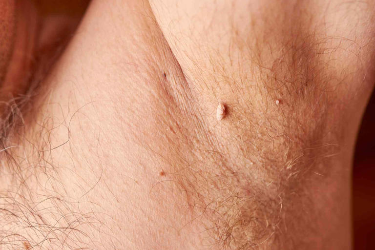 Wart vs. Skin Tag: How to Identify Which One You Have