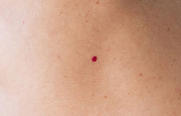 Ce petit point rouge sur votre peau ne part pas ? Voici ce que cela ...