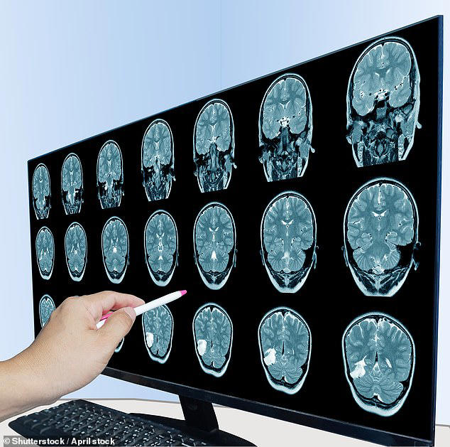 Scientists discover toxic substance hiding in 100% of people's brains