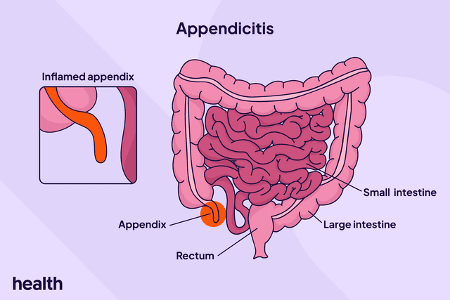 Understanding the 4 Stages of Appendicitis—and When To Seek Help