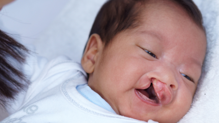 Is It Necessary To Get A Cleft Lift Surgery?